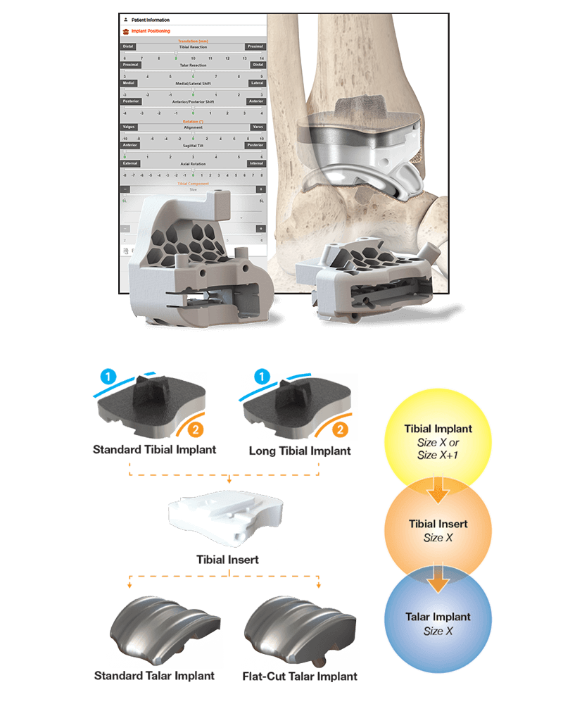 QUANTUM® Total Ankle System | CONMED