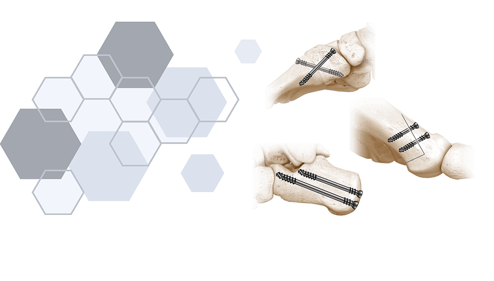 CoLag Compression Screws | CONMED