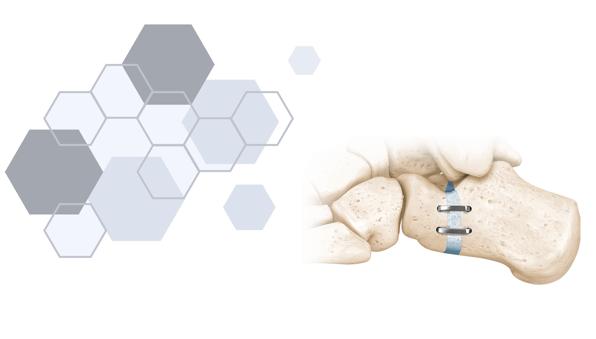 NeoSpan Compression Staples | CONMED