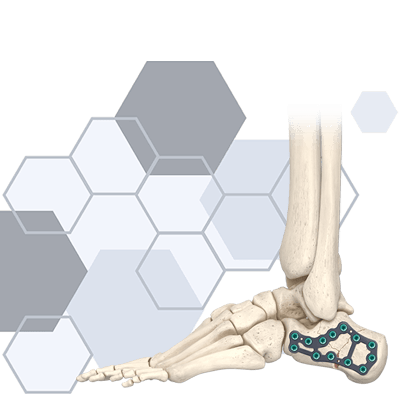 CoLink Cfx Calcaneal Fixation System | CONMED