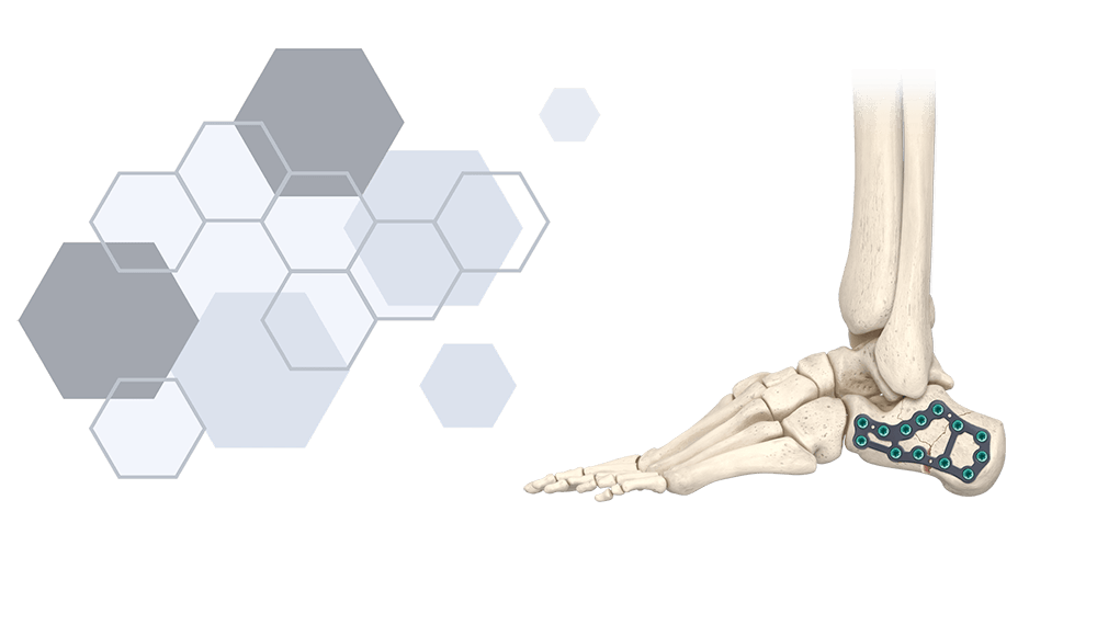 CoLink Cfx Calcaneal Fixation System | CONMED