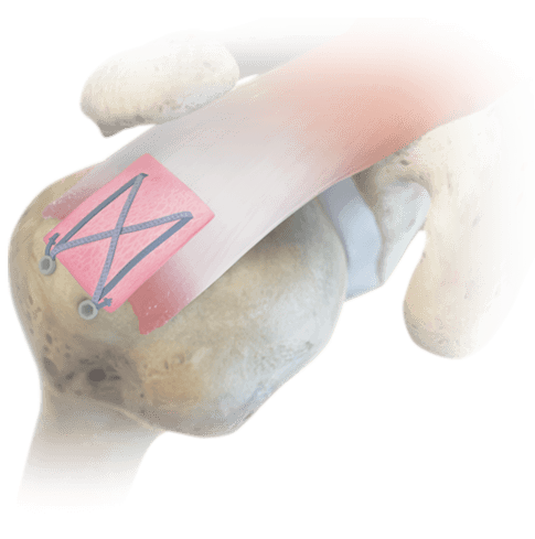 Elevate Your Rotator Cuff Augmentation | CONMED Blog